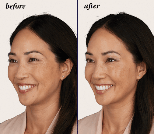 BOTOX Before & After Photos | Gambhir Cosmetic Medicine